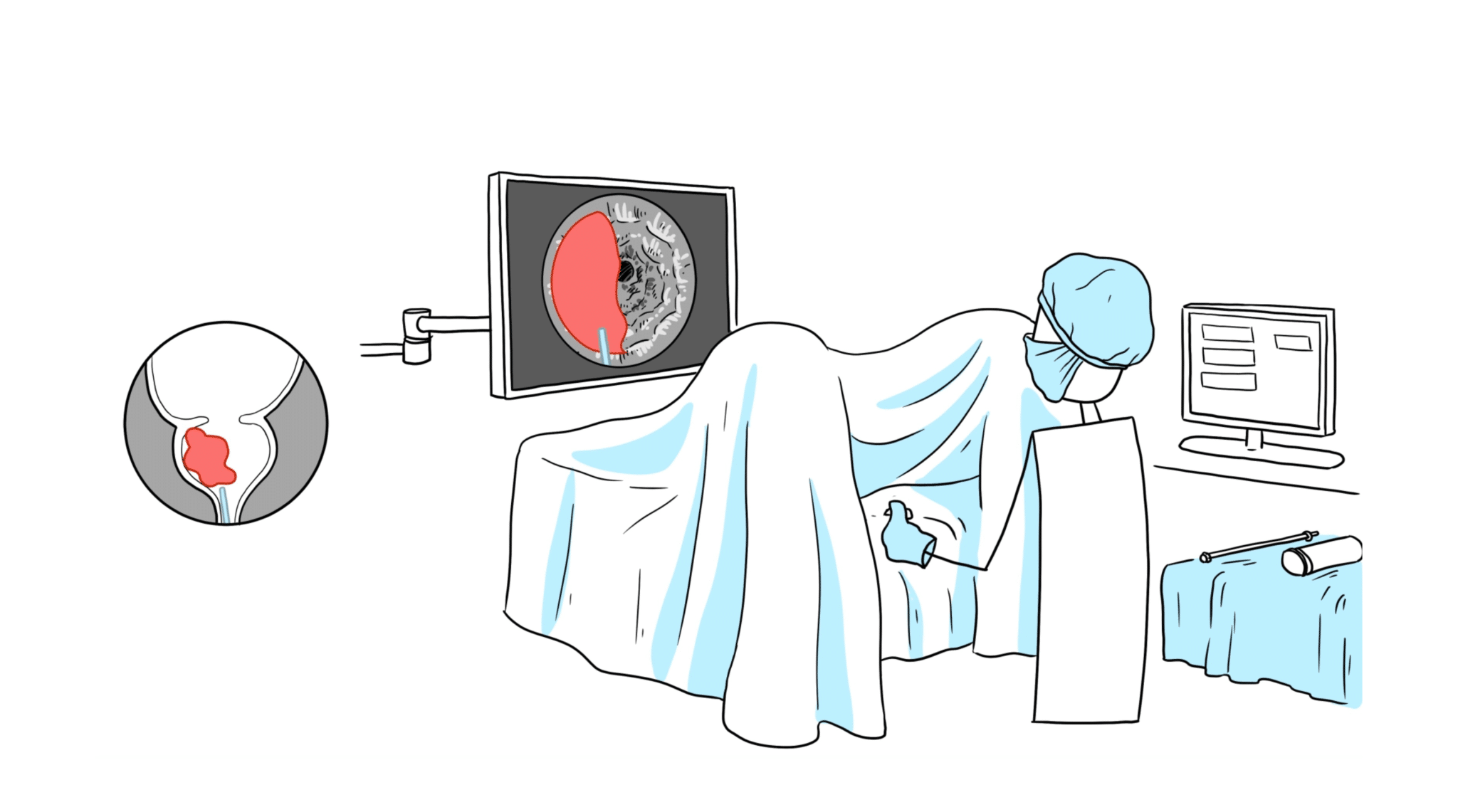 Adénome de la prostate : symptômes, diagnostic et infos